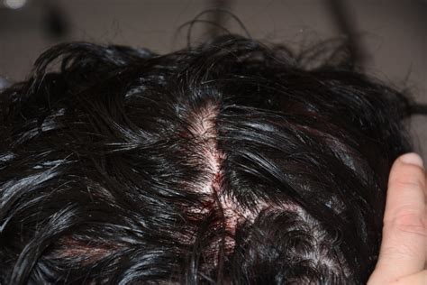 Scalp Tissue Expander Incision Closure Dr Barry Eppley Indianapolis Explore Plastic Surgery