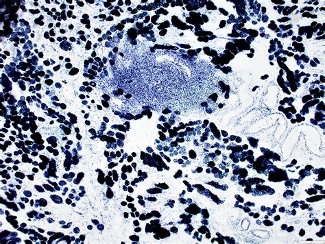 Thyroid Ophthalmopathy