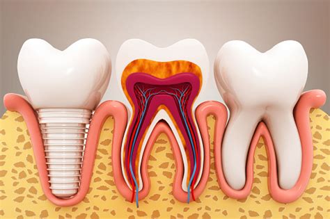 치과 임플란트 치아 단면 인간의 치아 또는 의치 수술 3d 그림 이빨에 대한 스톡 사진 및 기타 이미지 이빨 에나멜 치아 임플란트 Istock
