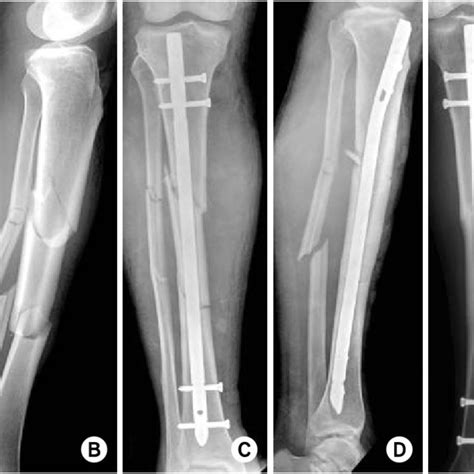 A B Preoperative Radiographs Of A Year Old Man Show A Tibia Download Scientific Diagram