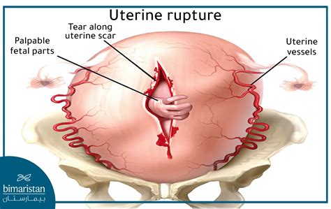 Uterine Rupture Causes And Treatment In Turkey Bimaristan