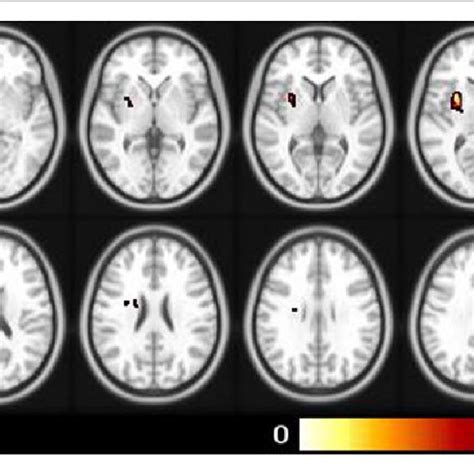 Pdf Lesion Characteristics Of Individuals With Upper Limb Spasticity