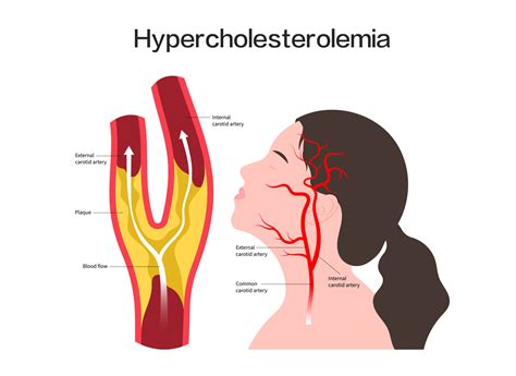 Hypercholesterolemia How To Identify Risks And Successfully Manage It Healthcare520
