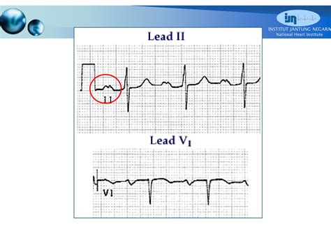Cvt Mohd Farid Basic Ecg Part Iii P Wave And Pr Interval