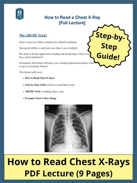Read And Interpret Chest X Rays The Abcde Mnemonic Step By Step Bilarasa