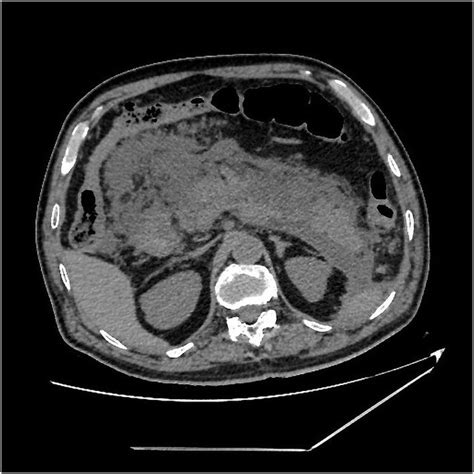 Pulsatile Bleeding Of The Duodenal Papilla After The Clots Were Removed