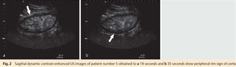 Acute Cortical Necrosis Semantic Scholar