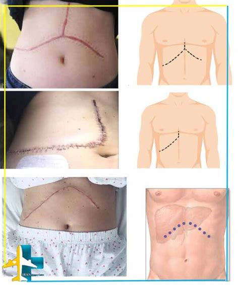 Liver Transplant In Iran Ultimate Guide Plus Prices Iran Surgery Center