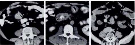 Three Patterns Of Calcification Within Mesenterlc Carcinoid Tumor A Download Scientific