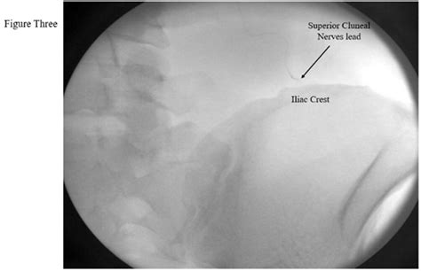 Ep187 Peripheral Superior Cluneal Nerve Stimulation For Intractable Low