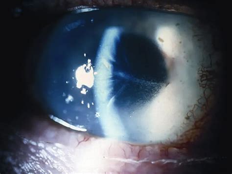 Toxic Anterior Segment Syndrome Tass American Academy Of Ophthalmology