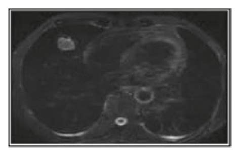 Mri Features Of Different Types Of Lung Nodules A Pulmonary Nodule Download Scientific
