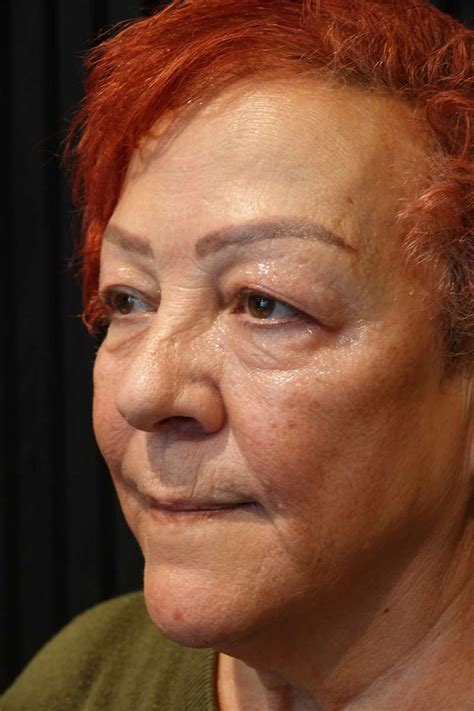 Non Surgical Blepharoplasty Dr Sw Clinics