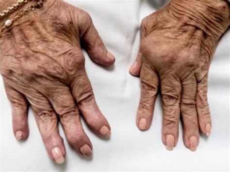 Methotrexate Nursing Considerations