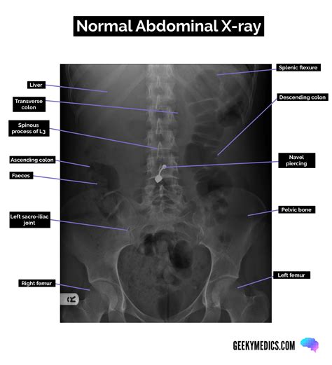 Normal Abdominal X Ray Gasless Abdomen In The Adult What Does It