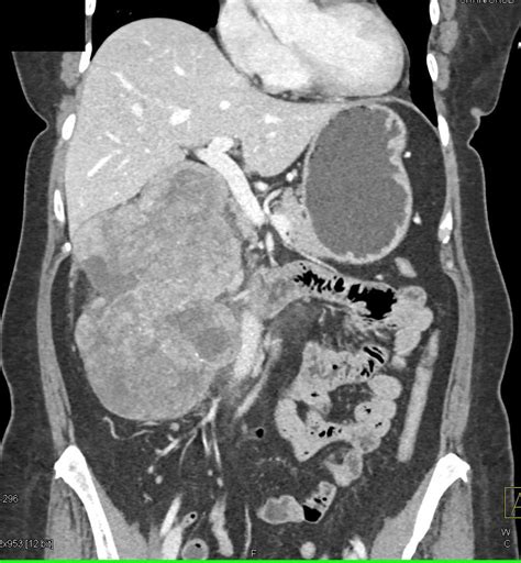 Vascular Small Bowel Gist Tumor Small Bowel Radiology Case Studies Ctisus Ct Scanning