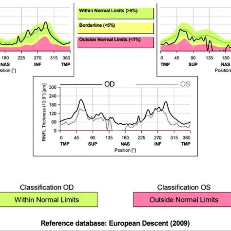 Oct Rnfl Showing Normal Appearance In Od Nasal And Temporal Thinning Download Scientific