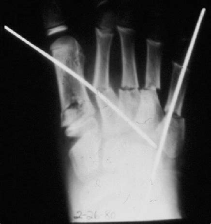 Metatarsus Adductus Pediatrics Orthobullets