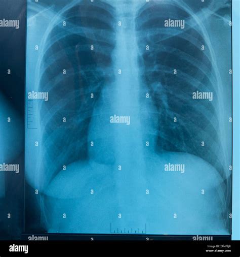 Farmers Lung Cxr