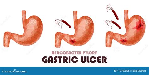 Duodenum Ulcer Affected Duodenal Ulcer Vector Illustration On A Background Of Isolation