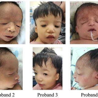 Pdf Mutation Analysis Of Tcof1 Gene In Chinese Treacher Collins Syndrome Patients