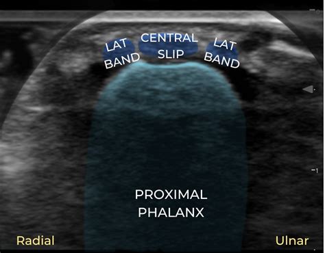 Hand Msk Ultrasound Rita Chorba Dpt