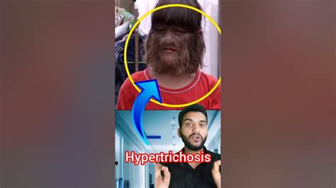 Hypertrichosis Shorts Youtube