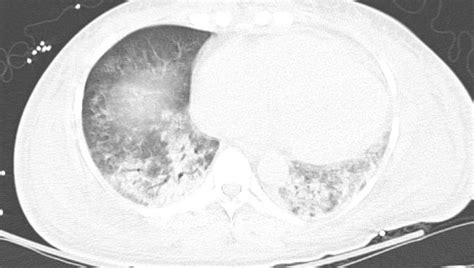 Ct Chest With And Without Contrast Diffuse Reticular Nodular Download Scientific Diagram
