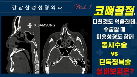 코뼈골절 수술할때 미용성형도 함께 동시수술vs단독정복술 실비보험은 Youtube