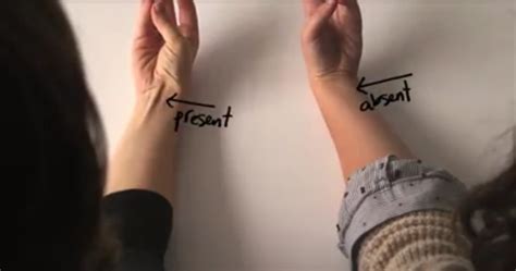 Here S Why This Video Of A Missing Arm Muscle Is Going Viral
