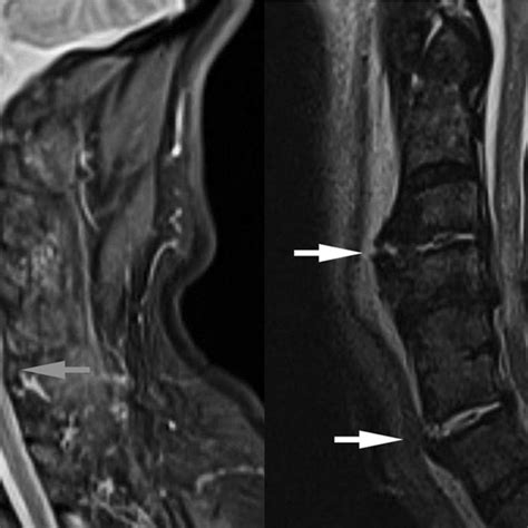 Segmental Instability And Cord Signal At Different Segments T2 Stir Download Scientific