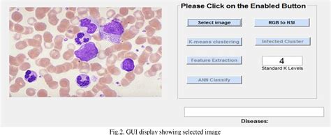 Figure 2 From Detection And Classification Of Leukaemia Using
