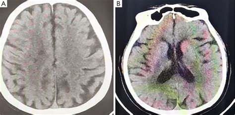 Brain Ct From December 2020 Multiple Brain Metastases Disappeared Ct Download Scientific