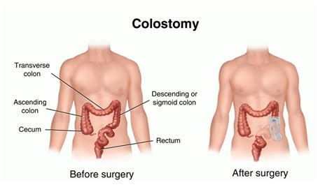 Colostomy The Australian Council Of Stoma Associations Inc