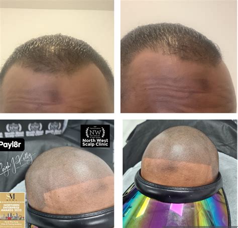 Gallery North West Scalp Clinic