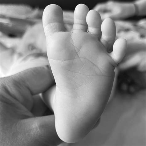 Deformity Metatarsus Adductus