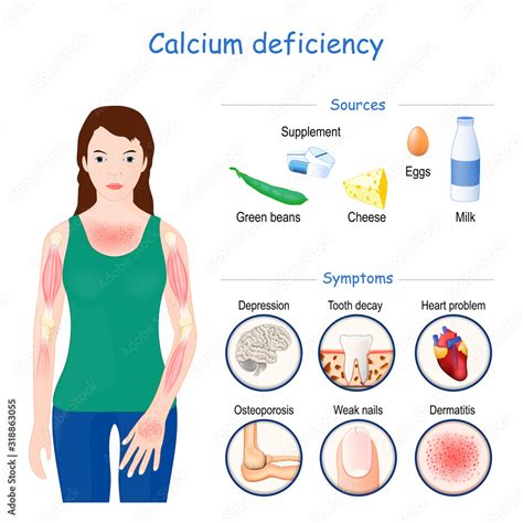 Calcium Deficiency Sign Symptoms And Sources Stock Vector Adobe Stock