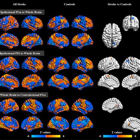 Disrupted Effective Connectivity Between Stroke Patients Presenting