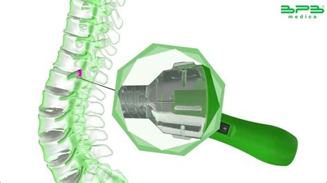 Diskom™ Percutaneous Discectomy Probe Youtube
