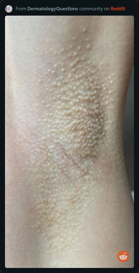 Lots Of Small Bumps On Armpit Skin R Dermatology
