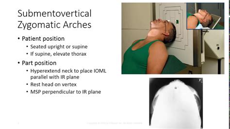 Zygomatic Process Radiograph