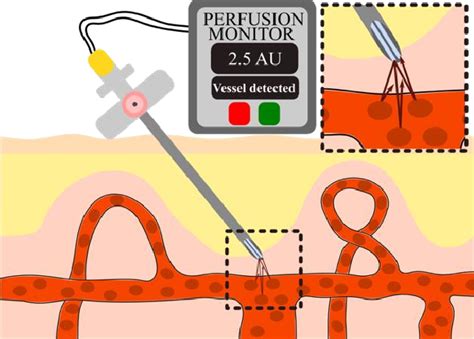 Figure 1 From Potential Of Laser Doppler Flowmetry In The Medical Needle Insertion Procedures