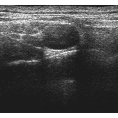 An Image Of Brachial Plexus Block At Axillary Level Note There Were Download Scientific