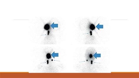 Sentinel Node Biopsy In Oncology A Breif Overview Pptx