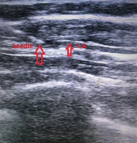 Pecs Block Local Anesthetic At Homer Bautista Blog