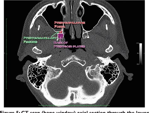 Ct Anatomy Of Pterygopalatine Fossa At Elaine Boehme Blog