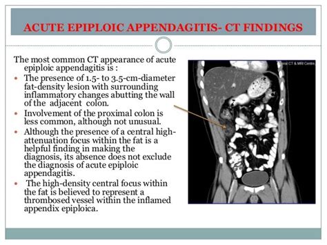 Epiploic Appendagitis A Benign Process At Risk Of