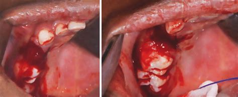 A And B Extraction And Hemostasis Management Of 54 A B Download