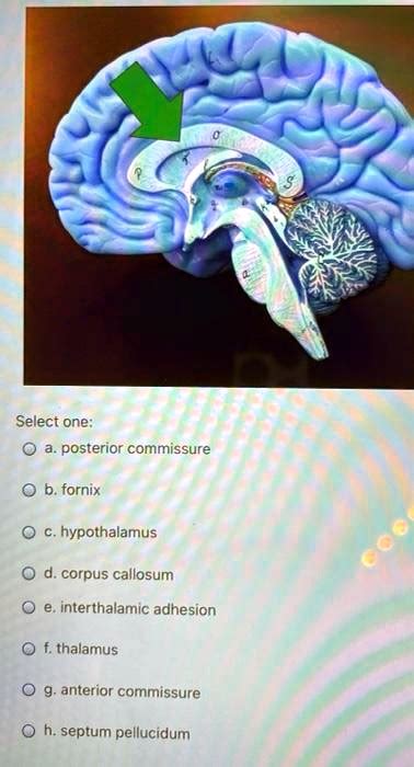 Solved A Posterior Commissure B Fornix C Hypothalamus D Corpus Callosum E Interthalamic