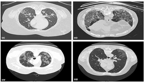 Ultra Early And Early Stage Of Chest Ct Findings Ultra Early Stage A